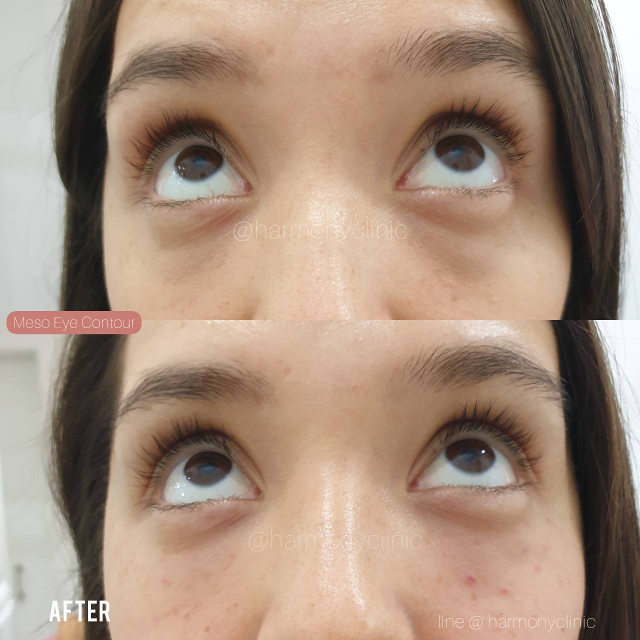 ผิวรอบดวงตาสดใส มีสเน่ห์น่าหลงใหล 😍ด้วย MESO Eye Contour @Harmony ...